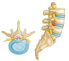 ≫OPERACIÓN DE UNA HERNIA DISCAL L5- S1 - ⊛ Clínica OMNIA